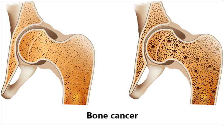 Early Detection of Bone Cancer | The Kolkata Mail